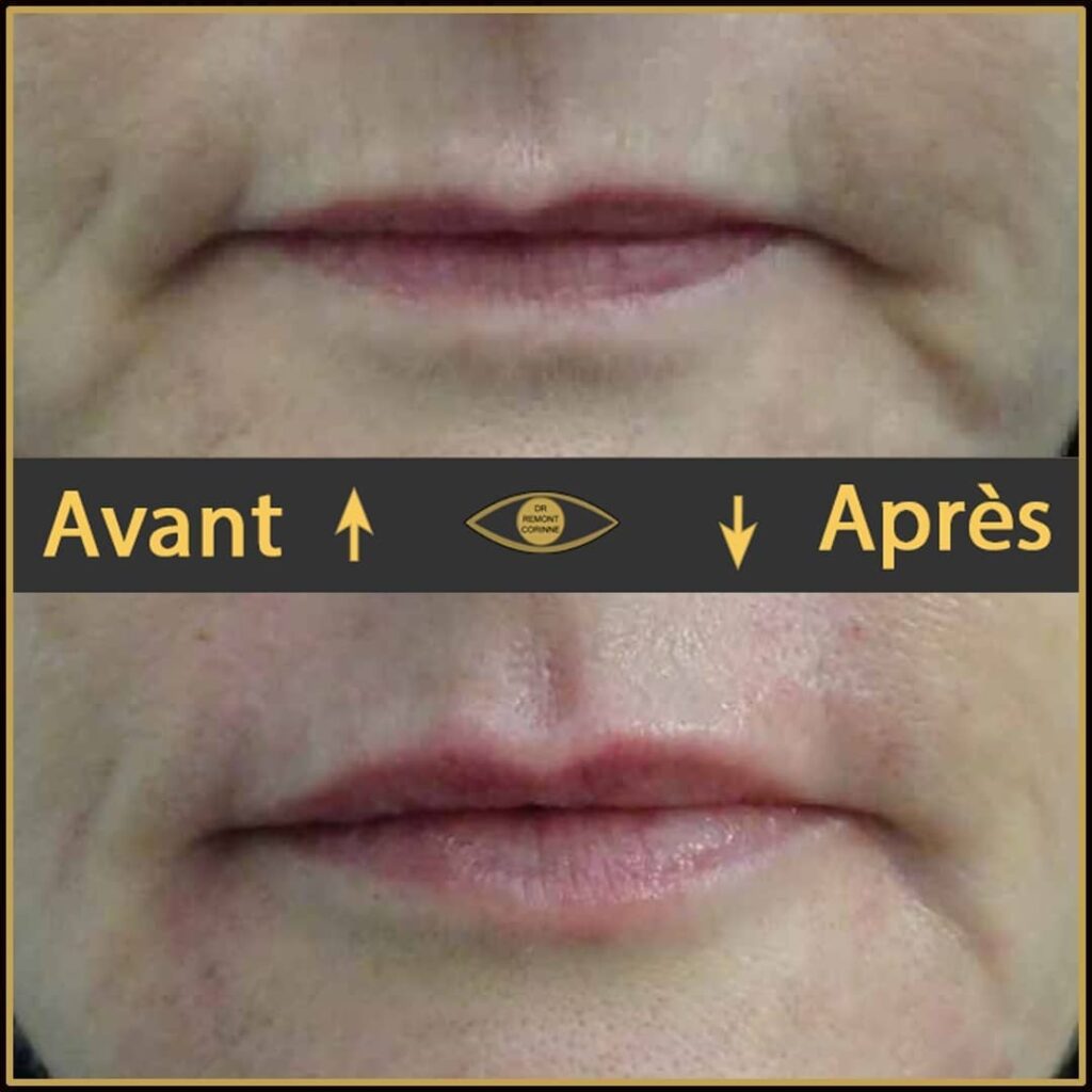 Cas cliniques - Dr Corinne Remont - Esthétique Le Touquet, Hesdin ...